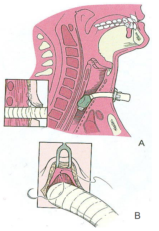 1.16: Laryngectomy- Supraglottic - Medicine LibreTexts
