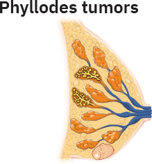 8.3: Cancer of the Breast - Medicine LibreTexts