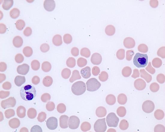 7.2: Blood Smear Examples - Medicine LibreTexts